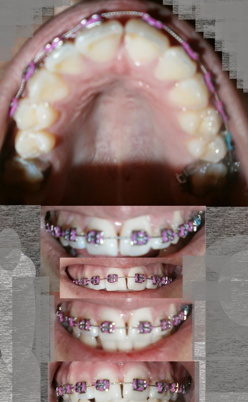 Mis Brackets: Paso a Paso [Mi experiencia]: Cambio de Ligas 03-07-2014