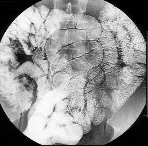 Hello USA: enteroclysis