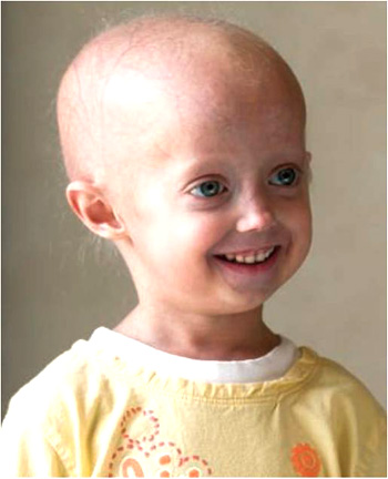 Noticias de ciencia: Descubren un tratamiento prometedor para la progeria