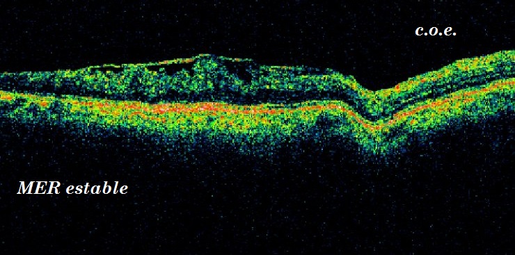 DEGENERACION MACULAR : OCT retina V