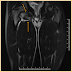 Obturator externus tear-MRI - Sumer's Radiology Blog