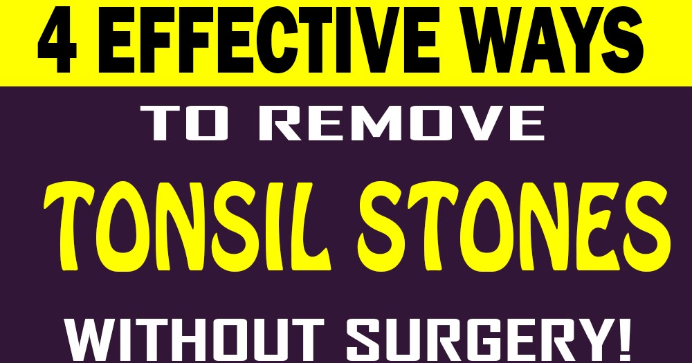 4 EFFECTIVE WAYS TO REMOVE TONSIL STONES WITHOUT SURGERY - HEALTH and WELLNESS