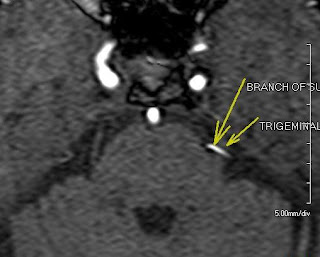Trigeminal Neuralgia-MRA - Sumer's Radiology Blog
