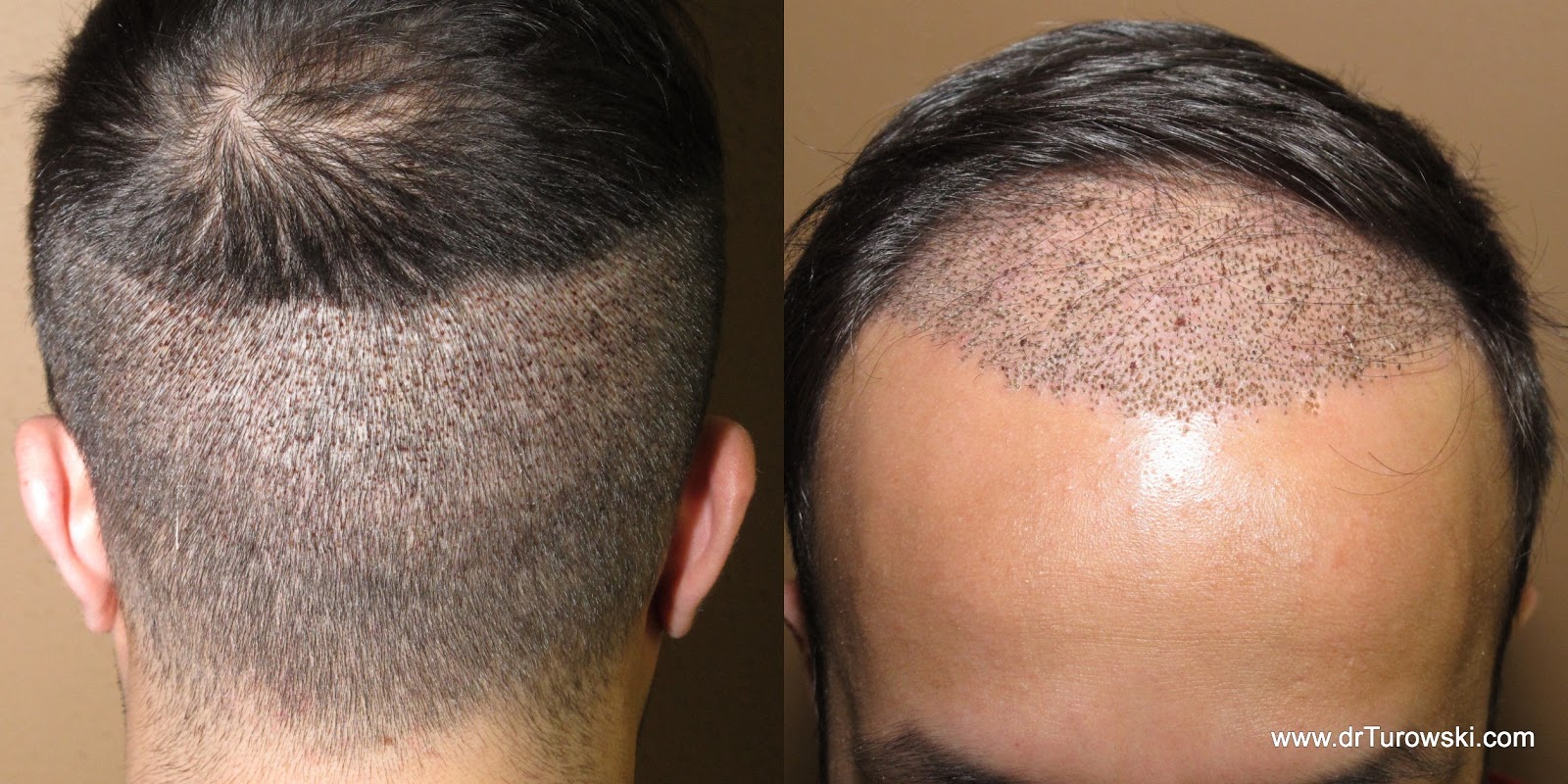 New Horizons Plastic Surgery Robotic Hair Transplant Just 1 Week
