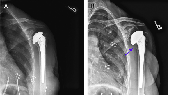 Stress shielding, component positioning with the Arthrex humeral stems ...