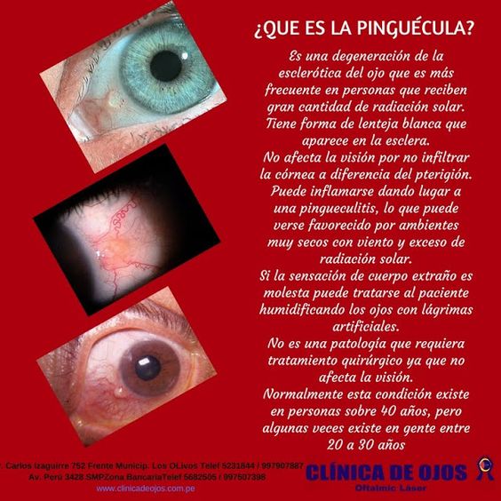 Clínica de Ojos Oftalmic Láser: QUE ES LA PINGUÉCULA