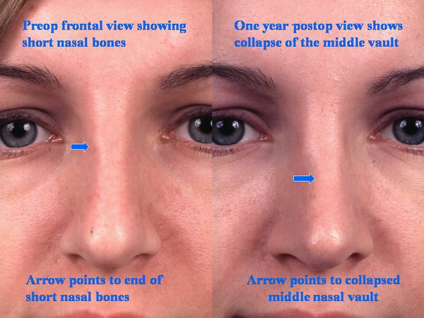 Dr. Dean Toriumi Reviews: Can Dr. Toriumi work with big and wide noses?