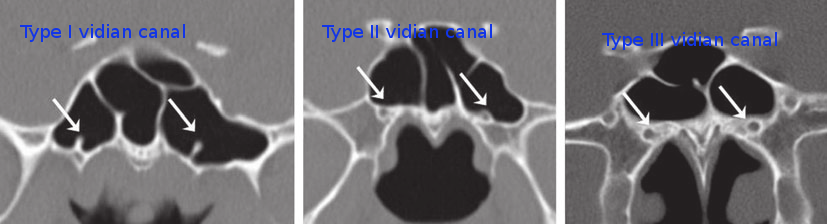 Skull and Spine: The Vidian Canal