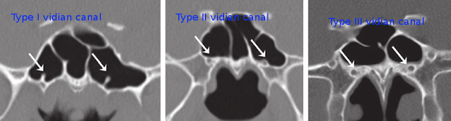 Skull and Spine: The Vidian Canal