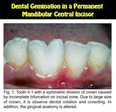 PDF: Dental Gemination in a Permanent Mandibular Central Incisor: an ...