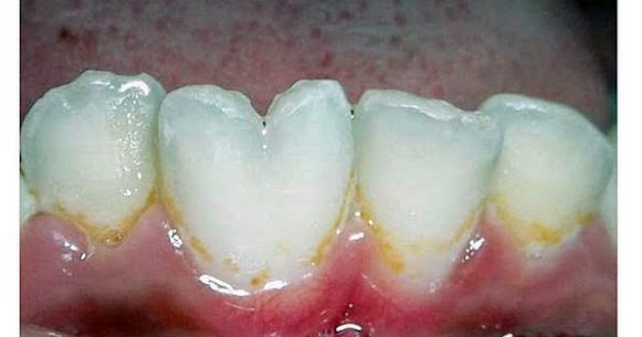 PDF: Dental Gemination in a Permanent Mandibular Central Incisor: an ...