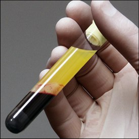 SS17 for Perfectly You: TERAPI PLASMA DARAH / PRP