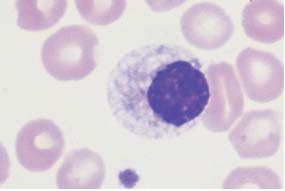 [Haematology] Abnormalities of the White Cell Series | Free Medical Atlas