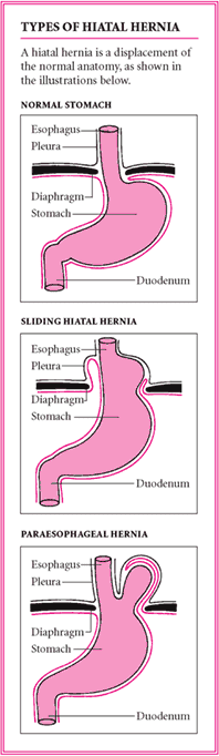 Hiatus Hernia Info: February 2012