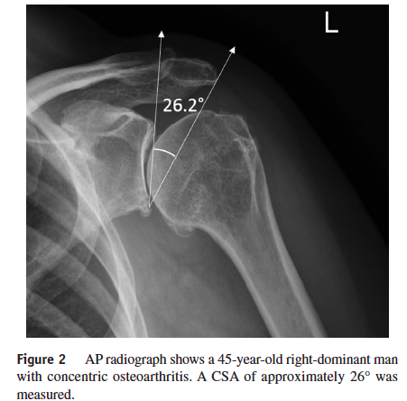 UW Shoulder and Elbow Academy: The 'critical' shoulder angle- cause or ...