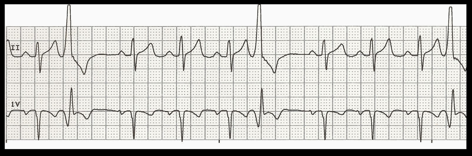 EKG Rhythm Strip Quiz 206