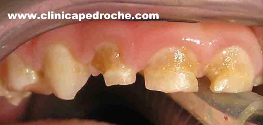 Una Boca para toda la Vida: Caries en los niños
