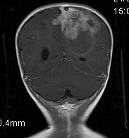 Atypical teratoid/rhabdoid tumors-MR - Sumer's Radiology Blog