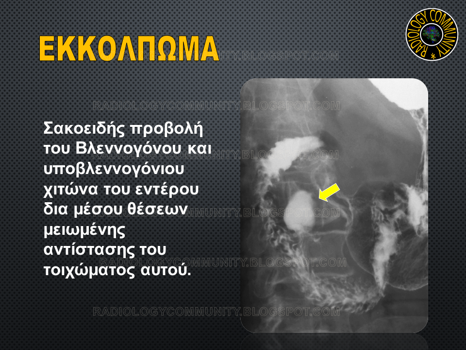 Radiology Community: Εκκολπώματα Δωδεκαδακτύλου: Η συμβολή της Κλασικής ...