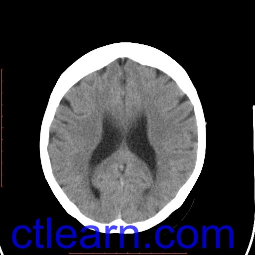 Diagnosis of a CT scan on the brain, with the report -2