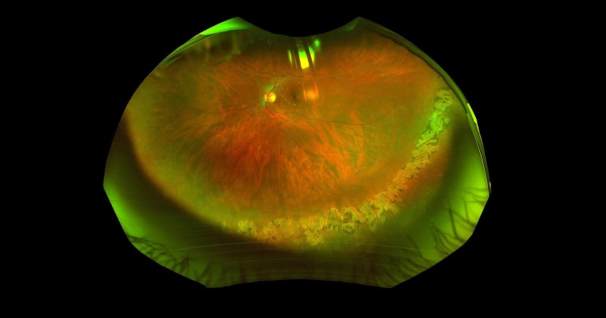 Sonoran Desert Eye Center: Pavingstone Degeneration