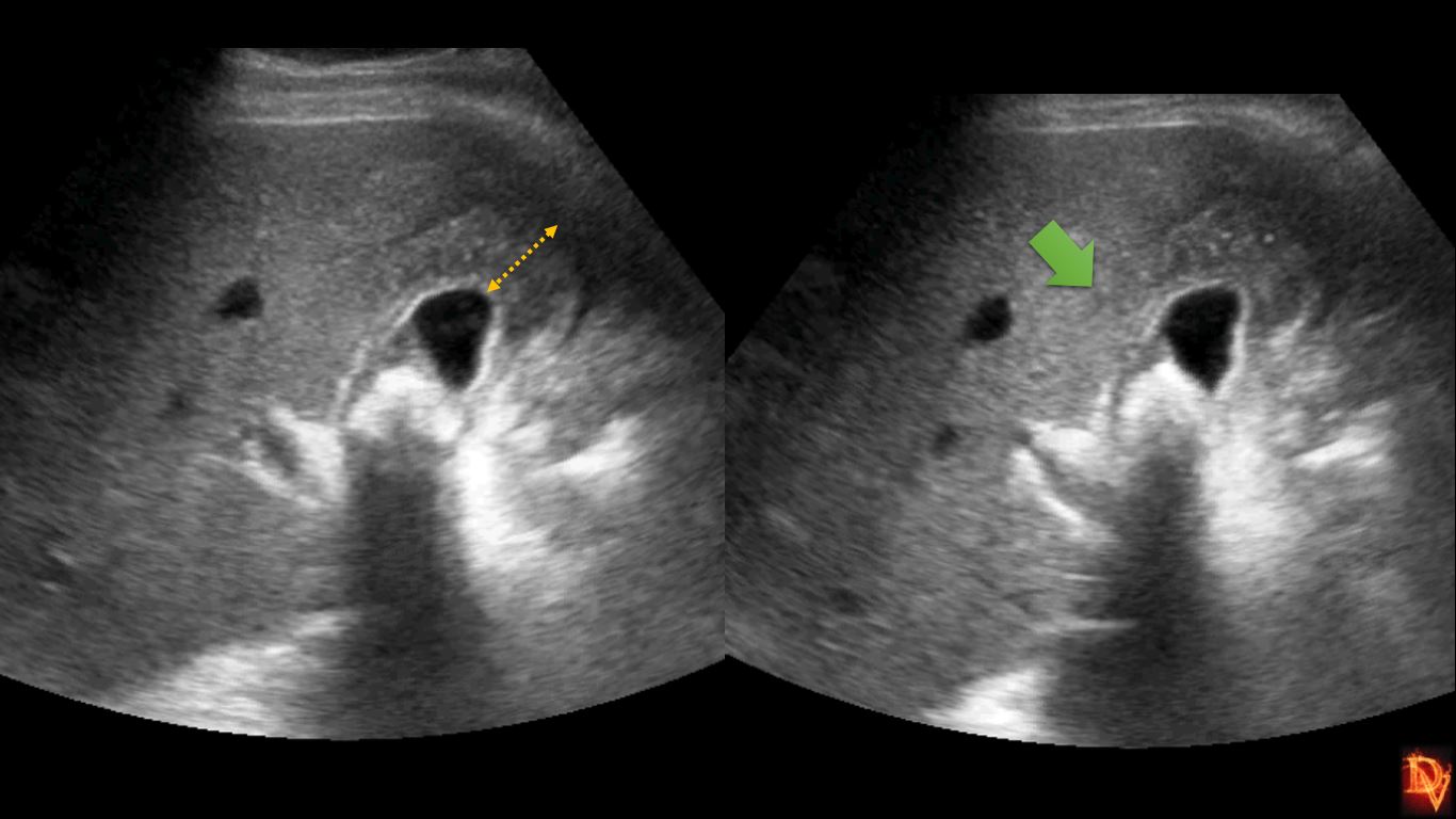 Ultimate Radiology : Xanthogranulomatous Cholecystitis (Histology from ...
