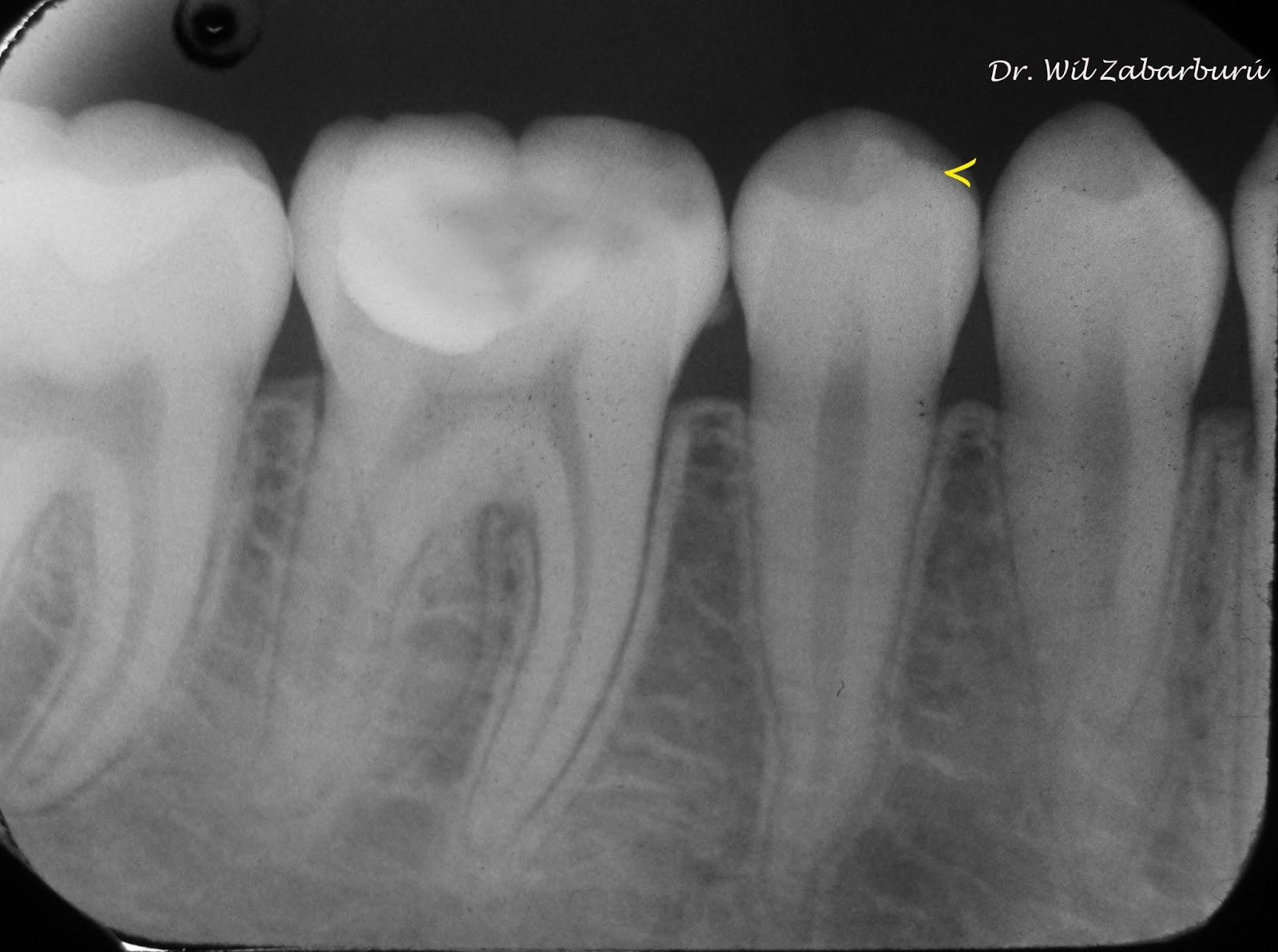 CLINICA DENTAL ASISTENCIAL: PREMOLAR DE LEONG