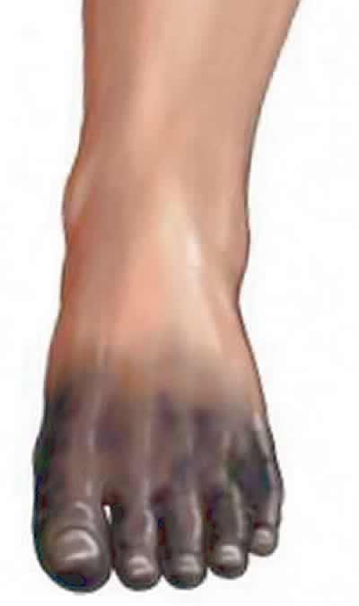 Nurse Health Guides : Prevention and Treatment of Buerger Disease ...