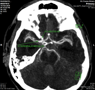 TEKNIK PEMERIKSAAN CT SCAN ANEURISMA ARTERI CEREBRALIS
