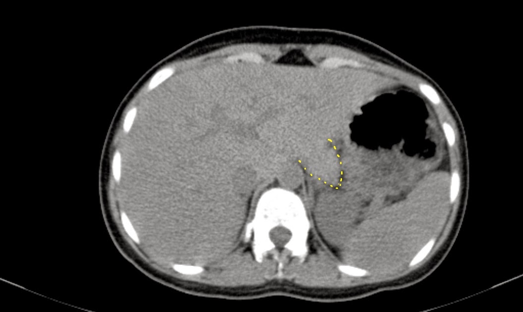 Ultimate Radiology : Pseudolesion : Papillary Process of Caudate Lobe