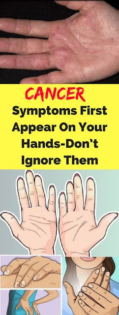 Cancer Symptoms First Appear On Your Hands-Don’t Ignore Them - WARM UP