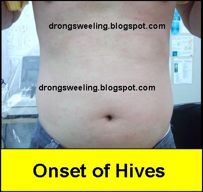 TCM News: Best TCM Doctors Treat Hives urticaria TCM Clinic