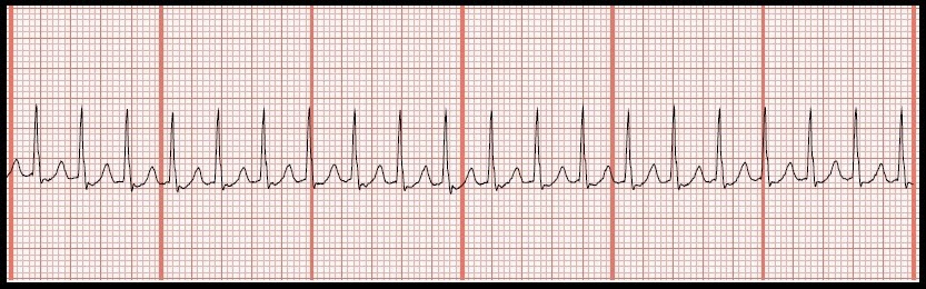 Various Supraventricular Tachycardias
