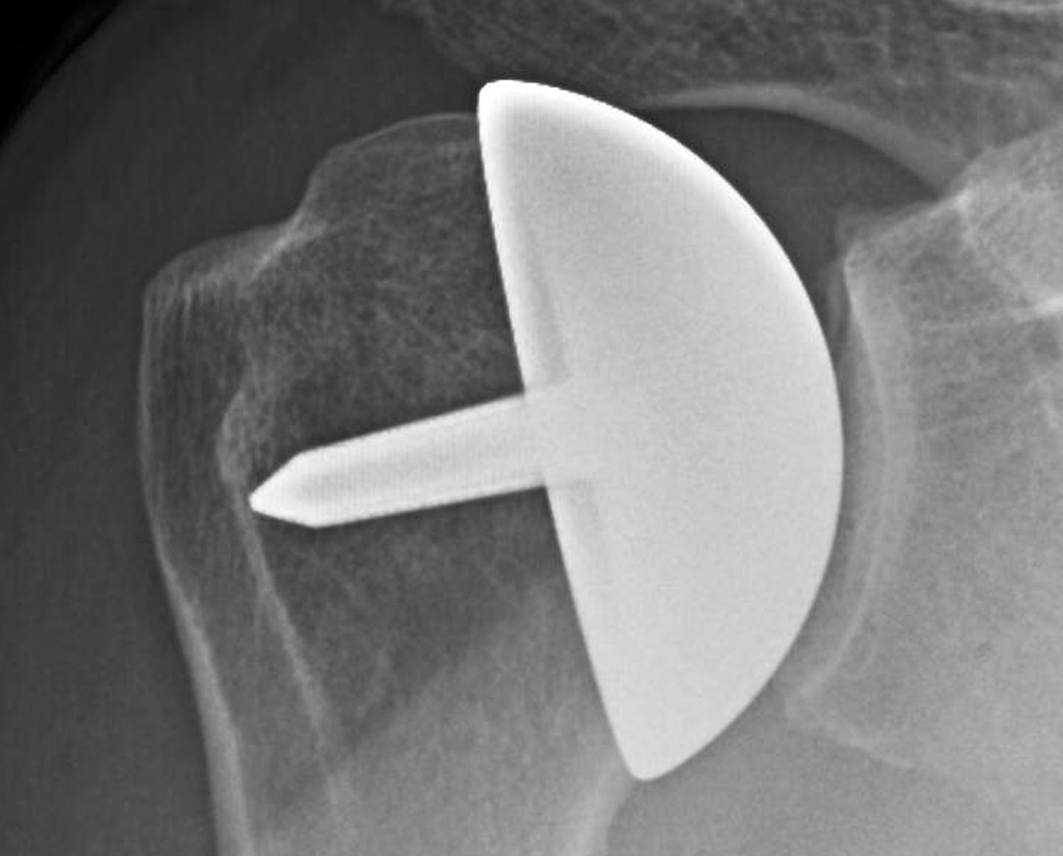 UW Shoulder and Elbow Academy: Shoulder joint replacement - selecting ...