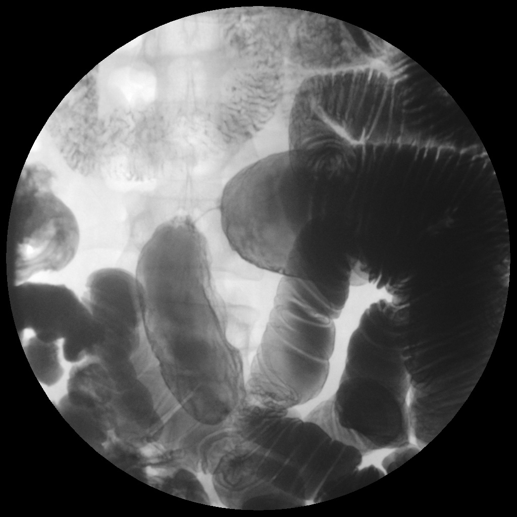 enteroclysis - USA News Collections