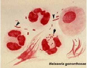 MEDIA UNTUK NEISSERIA GONORHOE ~ ageha flying