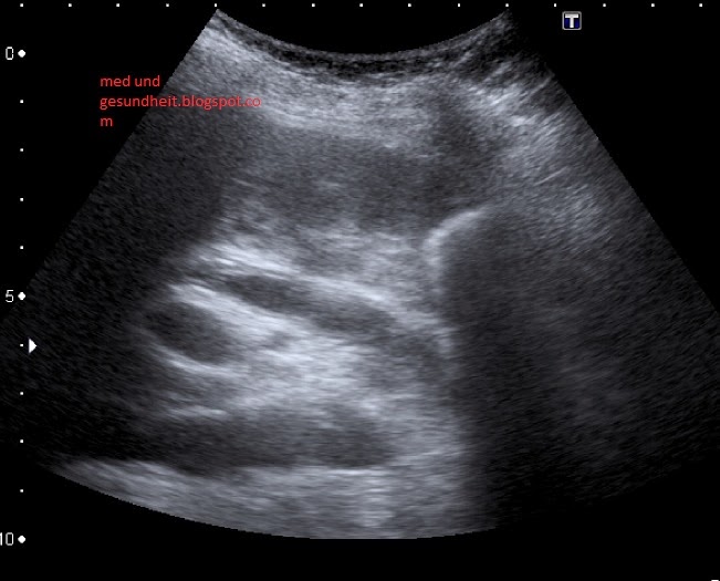 Medizin - Gesundheit: Sono Bild DHC Erweiterung der DHC bei ...