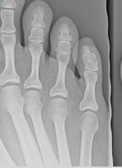 Lesser Toe Fracture-Plain Xray - Sumer's Radiology Blog