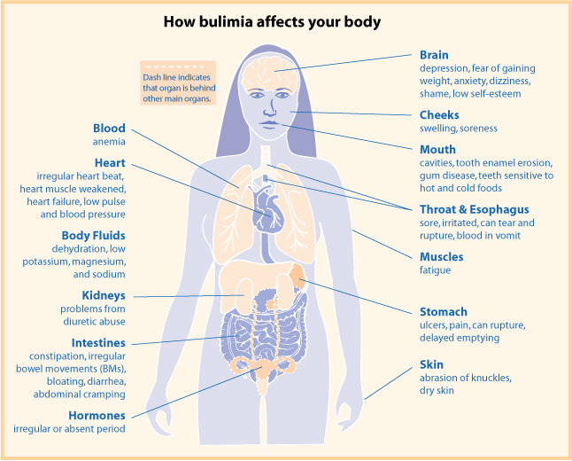 !!Bulimia Nervosa | Causes, Symptoms, Signs & Treatment Help* ~ Health ...