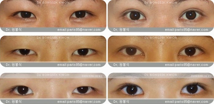 Teuim Aesthetic Plastic Surgical Clinic Dr.Kwon: What is non-incisional ...