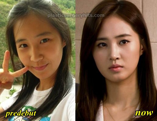 Kpop Star Kwon Yuri SNSD Plastic Surgery Before and After | Kpop ...
