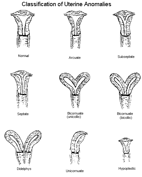 Birth Of Atticus Vba2c Bicornuate Uterus