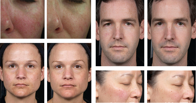 Perfect Body Laser and Aesthetics: Clear + Brilliant Perméa™ at Perfect ...