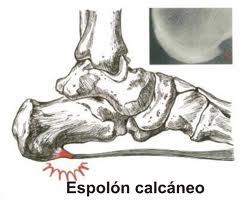 el fisio en casa: Fascitis plantar, pie cavo y espolón calcaneo ...