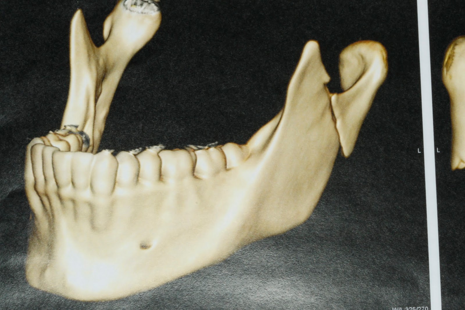 Fratura de Côndilo Mandibular