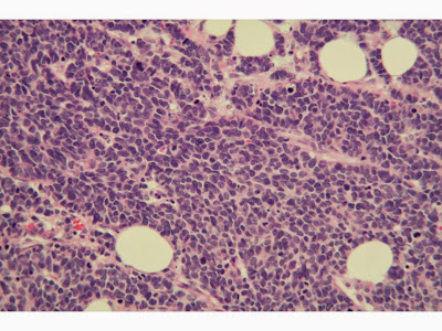 Dermpath Made Simple - Neoplastic: Merkel Cell Carcinoma