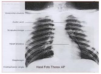 DIAMOND: TEKNIK RADIOGRAFI THORAX