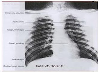 DIAMOND: TEKNIK RADIOGRAFI THORAX
