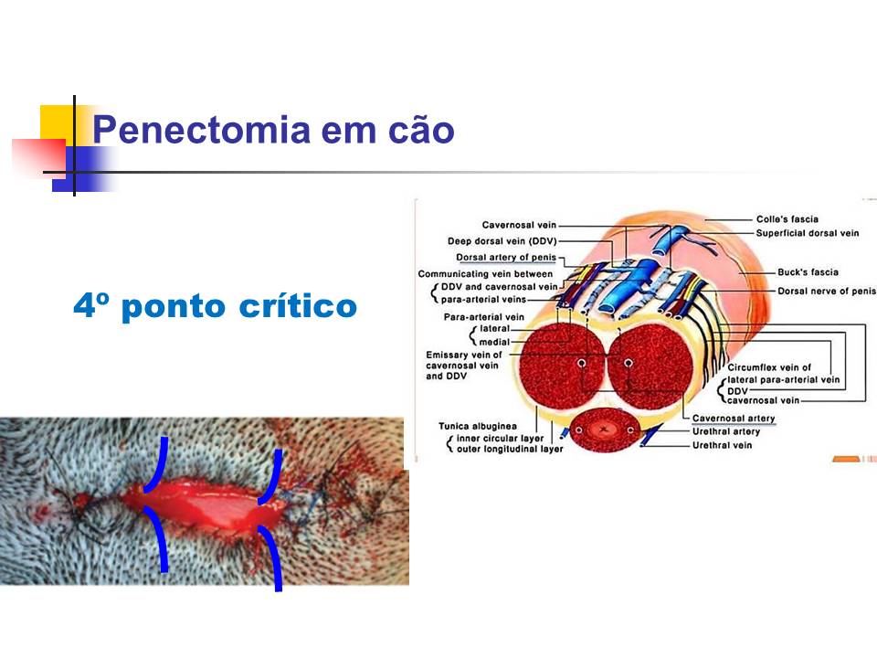 Palestra Uretrotomia, uretrostomia e penectomia: estenosou? Obstruiu?O ...