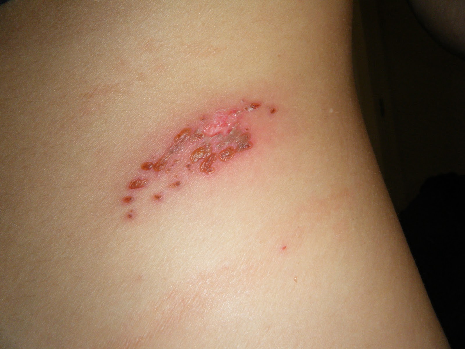 21 and Shingles: DAY 11: Yah scabby!!!!!!